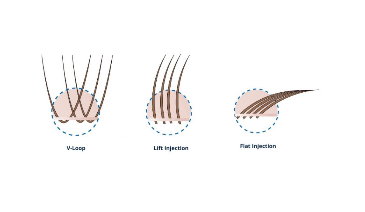 V-Loop vs. Injected Hair Systeme – Was ist der Unterschied? - Treat ...